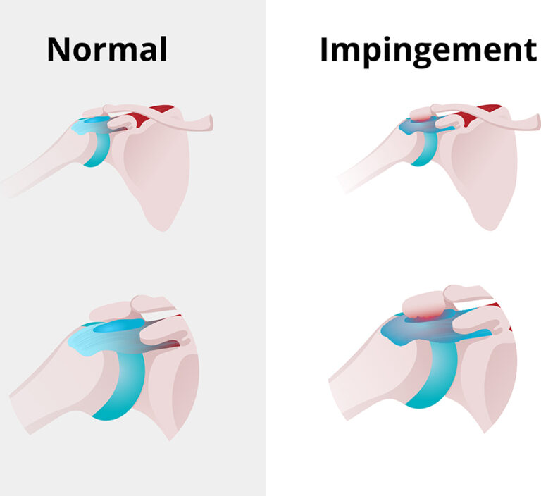 Shoulder Impingement - Exercise for Rotator Cuff | ECRC PT Blog